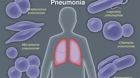 What Is Community Acquired Pneumonia
