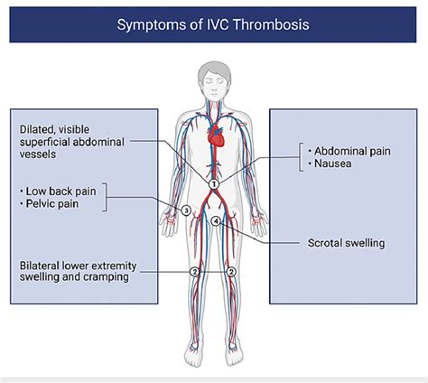 Symptoms Of Ivc Thrombosis Ivc Thrombosis And Duplicate Ivc Thrombosis