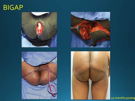 Perineal Proctectomy