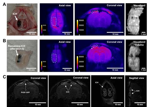 Injectable and tissue-conformable conductive hydrogel for MRI-compatible brain-interfacing ...