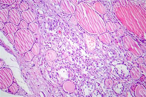 Fibrous Thyroiditis Light Micrograph Stock Image Image Of Medicine