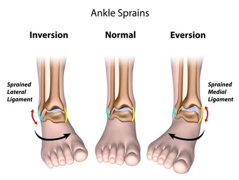 Ankle Sprain Treatment Preferred Foot And Ankle Specialists