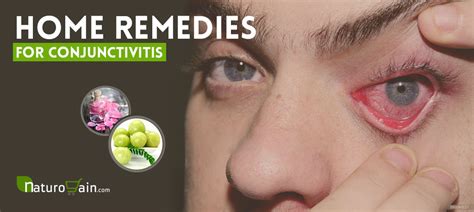 9 Best Home Remedies For Conjunctivitis To Prevent Pink Eyes
