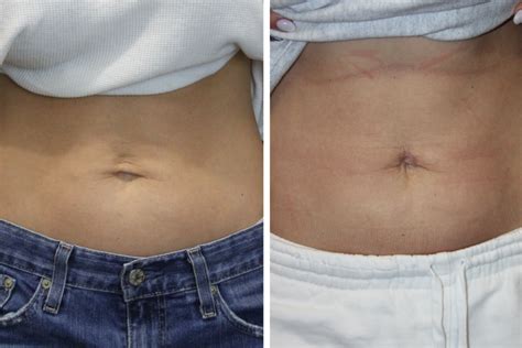 Umbilicoplasty Aesthetica Cosmetic Surgery And Laser Center