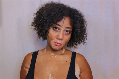 Simone G Zbd Talent Models With Disabilities Visible Differences And Trans And Non Binary