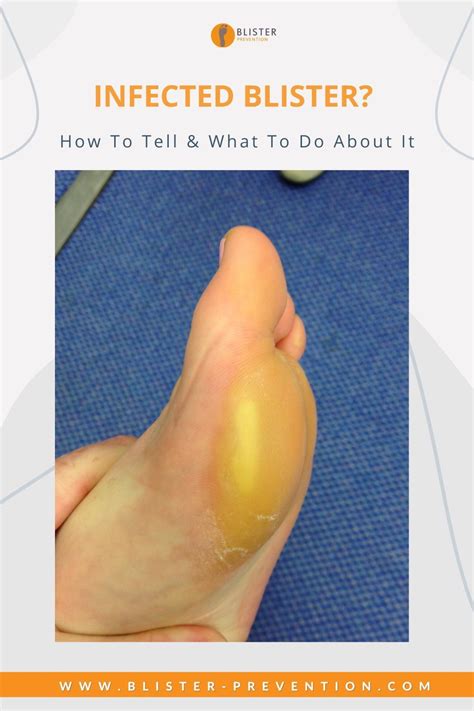 Infected Blister How To Tell What To Do About It Artofit
