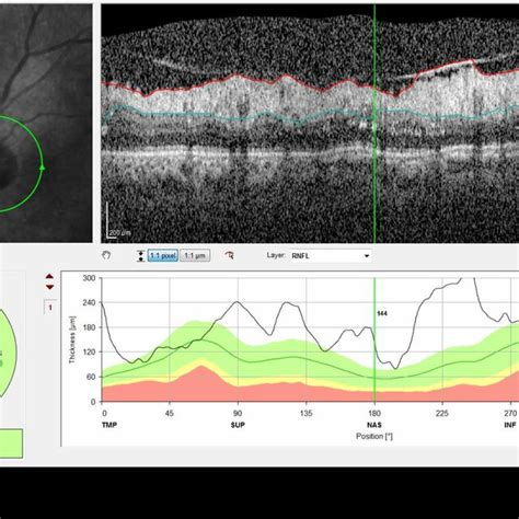 Preoperative Oct Image Of The Rnfl Thickness In Different Quadrants Of