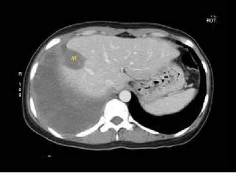 Chest Ct Scan Shows Hepatic Nodule With Hepatic Capsular Retraction Download Scientific Diagram