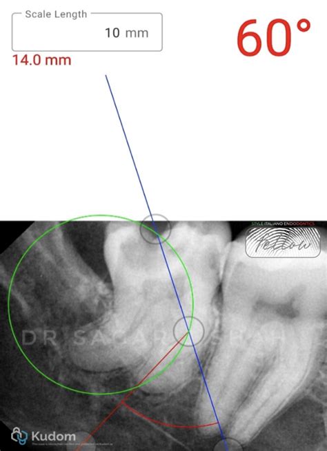 The Curve Conundrum Endodontic Management Of A Dilacerated Third Molar