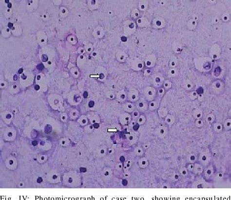 Figure Iv From Cryptococcal Lymphadenitis On Fine Needle Aspiration Cytology A Report Of 2