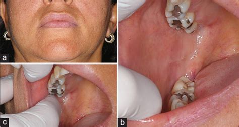 Phleboliths Of The Head And Neck Region A Case Report Pmc