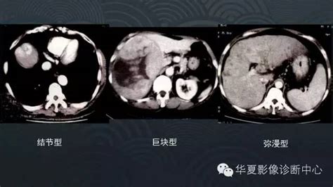 【ppt】肝细胞肝癌的分类及分期 影像ppt