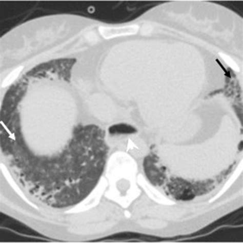 Predominantly Lower Lobe And Subpleural Reticulation White Arrows