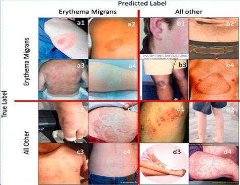 Erythema Migrans Rash