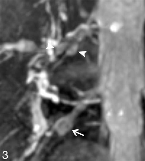 Morphologic Analysis Of Normal Human Lumbar Dorsal Root Ganglion By 3d