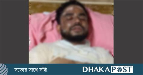 মেয়ের ছোড়া গরম তেলে ঝলসে গেলেন বাবা