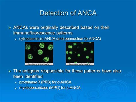 Anca Associated Vasculitis Ppt Video Online Download