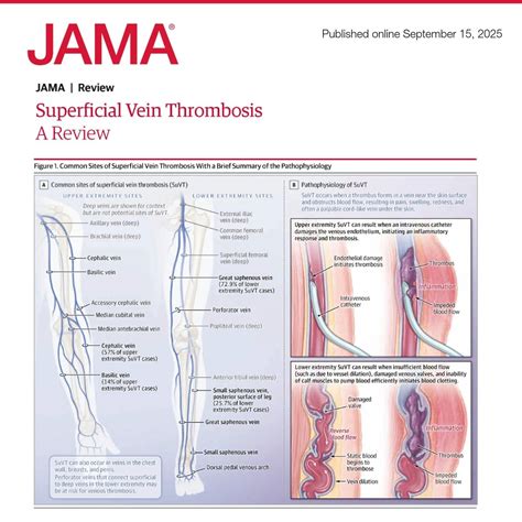 The Heart Superficial Vein Thrombosis A 2025review Facebook