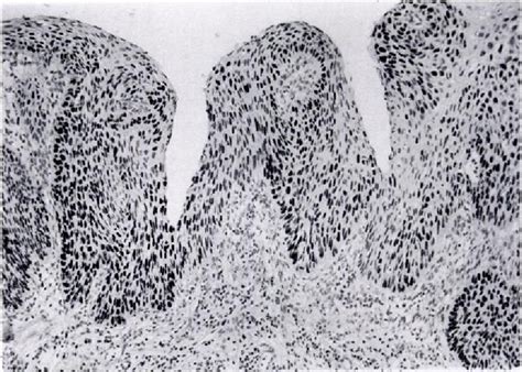 Basal Cell Hyperplasia Semantic Scholar