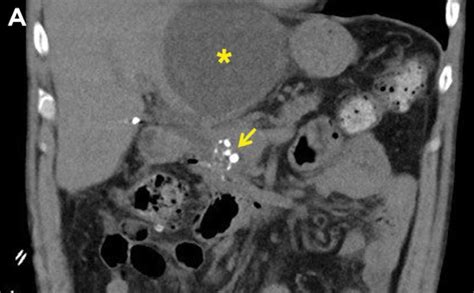 Pancreatic Cystic Lesions A Case Based Approach