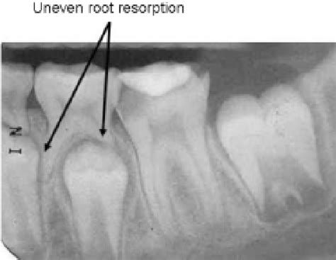 Figure 3 From Physiologic Root Resorption In Primary Teeth Molecular And Histological Events