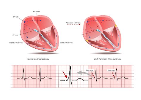 Wolff Parkinson White Syndrome Artofit