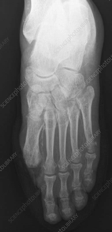 Toe Amputation In Diabetes X Ray Stock Image C0071979 Science