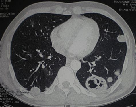 Wegeners Granulomatosis Presenting With Bilateral Excavated Nodules