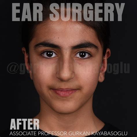 Ear Surgery Prof Dr Gürkan Kayabaşoğlu Maxillofacial Surgery