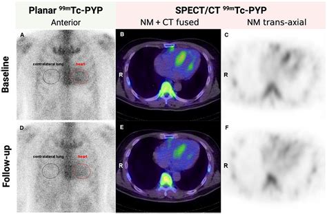 Use Of Technetium‐99m‐pyrophosphate Single‐photon Emission Computed