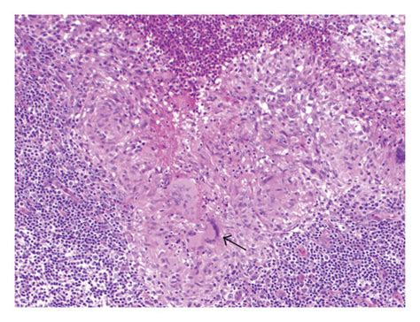 A B Hande Stain Showing Granulomatous Inflammation Of The Appendix