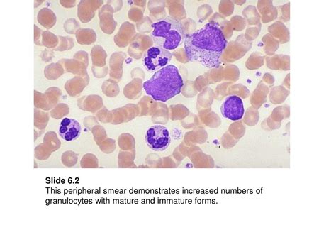 Immature Granulocytes High