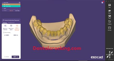 Exocad 32 Build 9036 Crack 2024 Dental Softwares