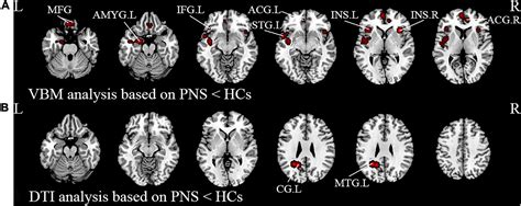 Frontiers Meta Analysis Of Structural And Functional Brain Abnormalities In Schizophrenia With