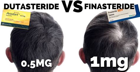 Topical Finasteride Vs Oral Finasteride Hairly