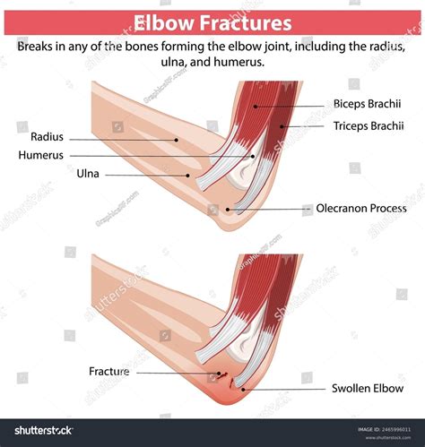 Detailed Diagram Elbow Fractures Stock Vector Royalty Free 2465996011