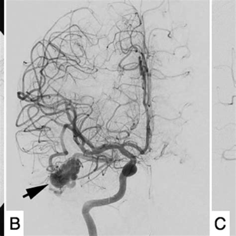 Classification Of Avms In Hht A Micro Avm Size Of The Lesion Is