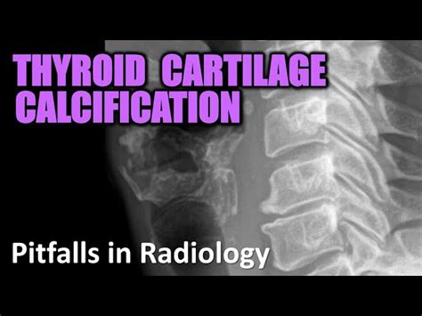 Thyroid Cartilage Xray
