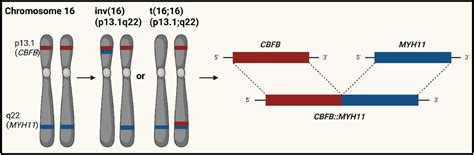 Acute Myeloid Leukaemia With The Type I Cbfbmyh11 Fusion A Rare
