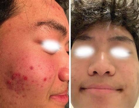 Co2 Ablative Laser Therapy Laser Aesthetic