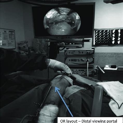 Theater Setup For Extrabursal Endoscopic Excision Of The Olecranon Download Scientific Diagram