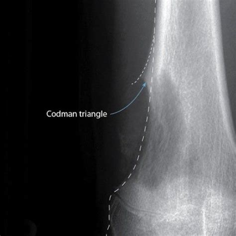 A Codman Triangle Is A Type Of Periosteal Reaction Seen With Aggressive Bone Lesions Due To