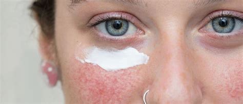 Qué Es La Dermatitis Tipos Causas Síntomas Y Tratamiento Blog Promofarma