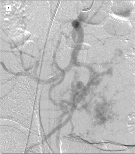 Imaging And Devascularisation Of Rare Hypervascular Placental Site