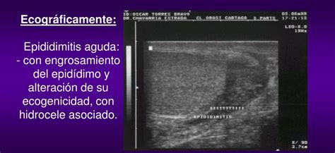 Ppt Ultrasonido De Testículos Powerpoint Presentation Free Download