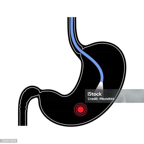 Gastroscopy Endoscopy Procedure Stock Illustration Download Image Now