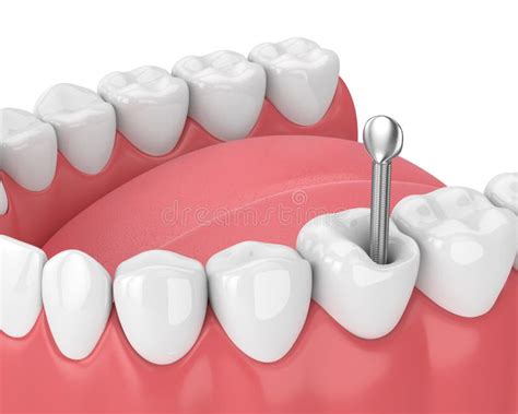 3d Render Of Jaw With Teeth And Dental Metal Post Stock Illustration