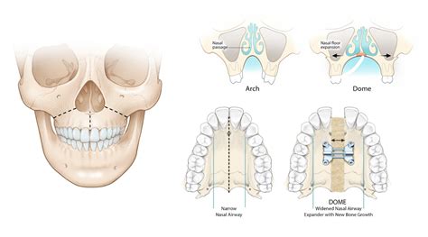 Rpe Rme Vs Marpe Mse Ease Vs Sarpe Dome Tmd Occlusion