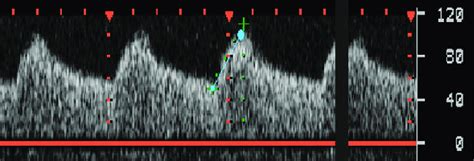 An Example Of Low Resistance Waveform Download Scientific Diagram