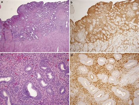 Ifitm1 Expression In Inactive Endometrium Strong And Diffuse Staining